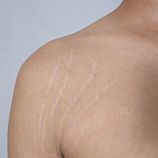 7 Best Stretch Mark Creams To Build Collagen In Your Skin | LBB